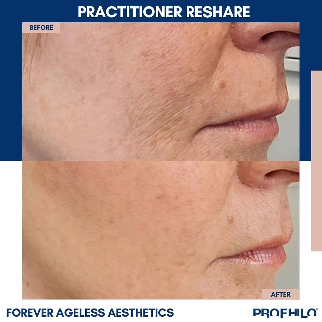 Profhilo Injections | Before and After | Doctor Medica