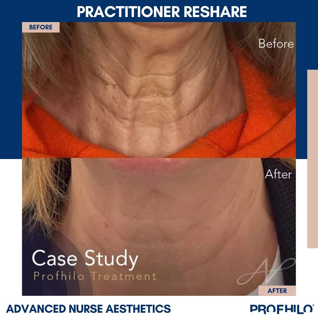 Profhilo Injections | Before and After | Doctor Medica