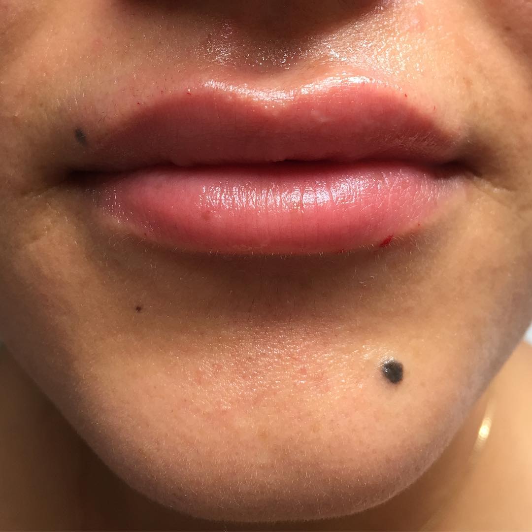 Emotional Impact: Filorga Injection Before & After | Doctor Medica