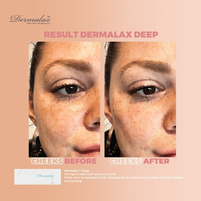 The Power of Dermalax Revealed | Doctor Medica