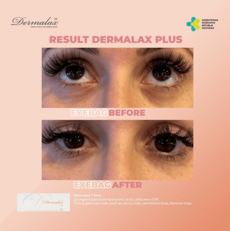 Dermalax Deep Plus Reviews | HA Acid Filler | Doctor Medica
