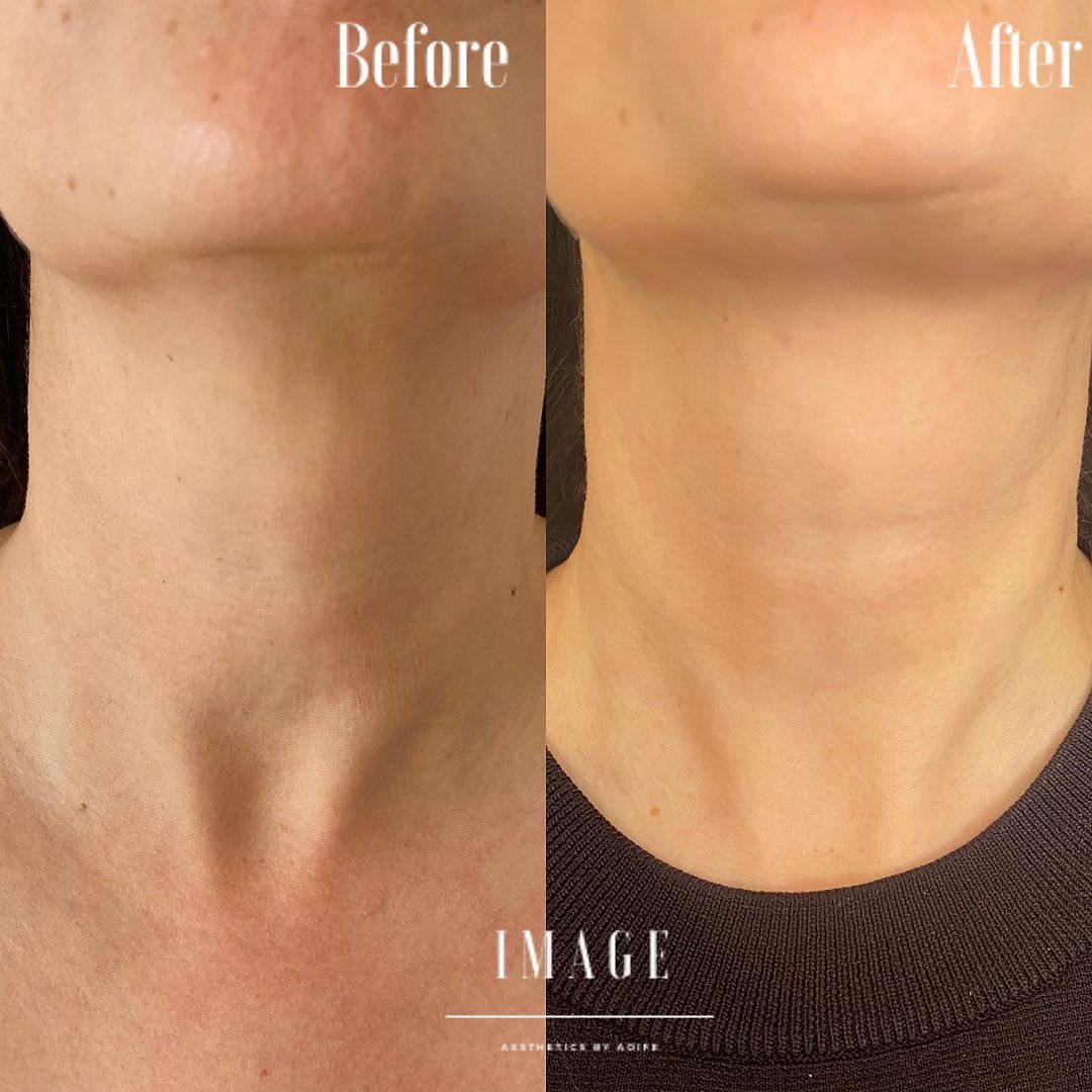 Complete Guide to Profhilo | Costs and Benefits | Doctor Medica