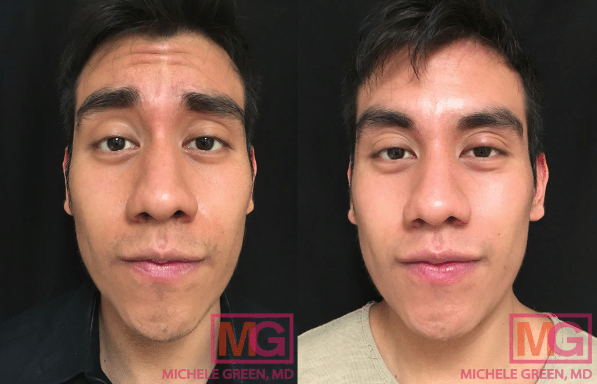 Maximizing Botox Effect: Step-by-Step Guide | Doctor Medica