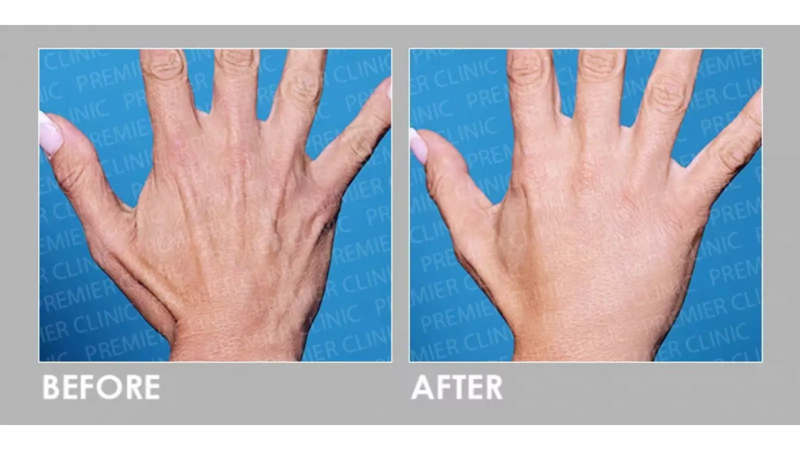 Sculptra Hands Restore Youthful Appearance Doctormedica